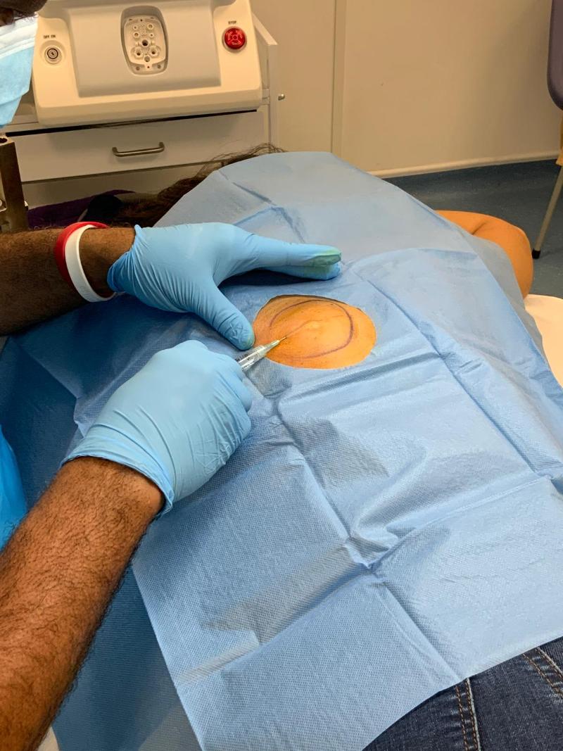 Lipoma Removal | Clearer Clinics